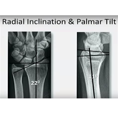 Distal Radius Fracture Classification Nichelery
