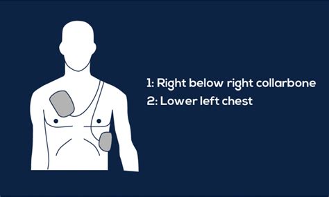 Guide To Aed Pad Placement Mdpro Usa
