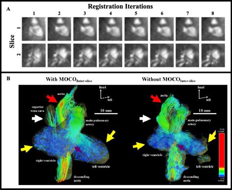 Comparison Of Slice To Volume Reconstructions Svrs With And Without Download Scientific