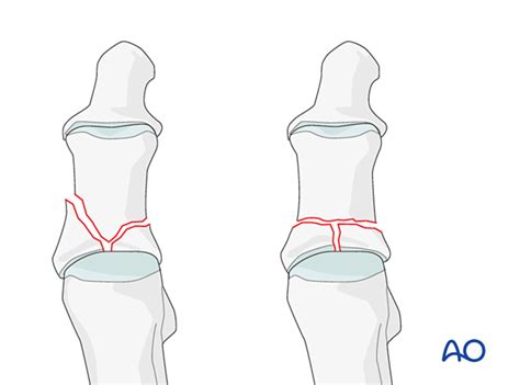 Complete Articular Fractures Of The Proximal Hallux