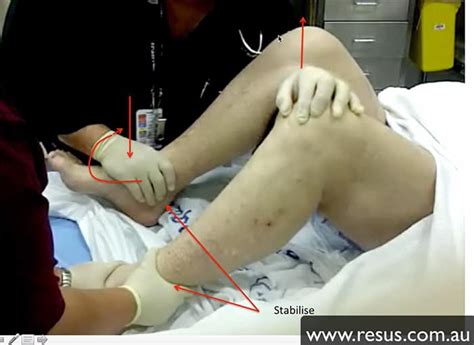 Hip Relocation Made Easy Resus