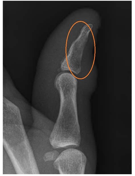 Imaging Case Of The Week 196 Answer Emergucate