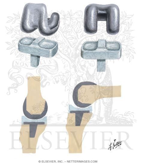 Total Condylar Knee Prosthesis