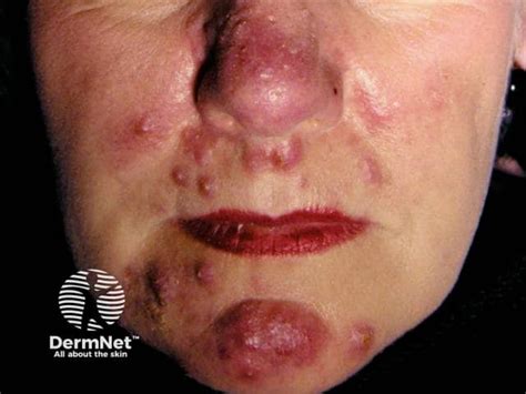 Dermnet Rosacea Rhinophyma Is A Skin Condition Affecting The Nose In