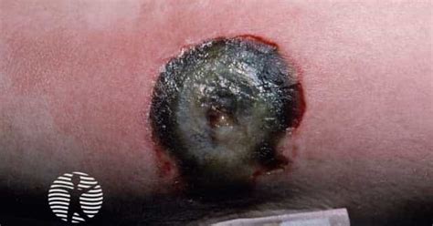 Pyoderma Gangrenosum Image