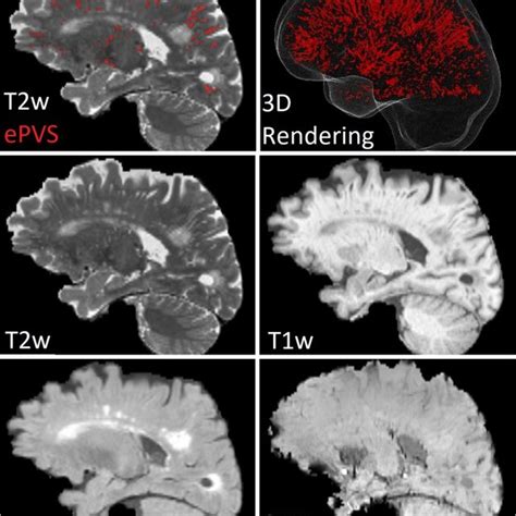 Examples Of Epvs In Different Mri Sequences Download Scientific Diagram