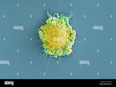 Images Not To Be Used By The Tobacco Industry Cervical Cancer Cell Coloured Scanning Electron