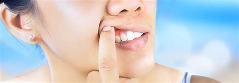 Gingivitis Symptoms Gentle Dental