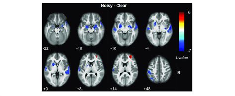 Brain Activation In Noisy Speech Processing In Contrast To Clear