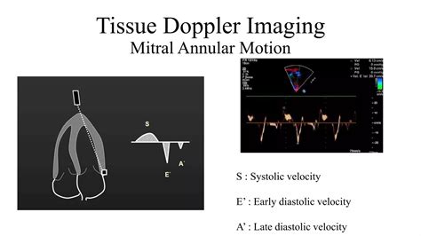 Left Ventricular Diastolic Dysfunction In Echocardiography Pptx Heart And Cardiovascular