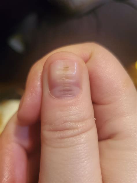 Why Do My Thumb Nails Have All These Bumps And Ridges Rcanskincare