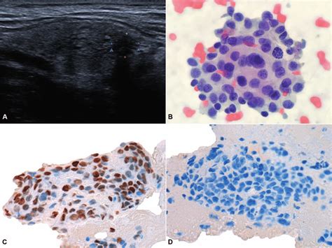 Metastatic Ductal Carcinoma Of The Breast A Solid Hypoechogenic