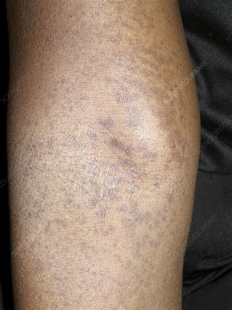 Atrophic Lichen Planus Stock Image C0611212 Science Photo Library