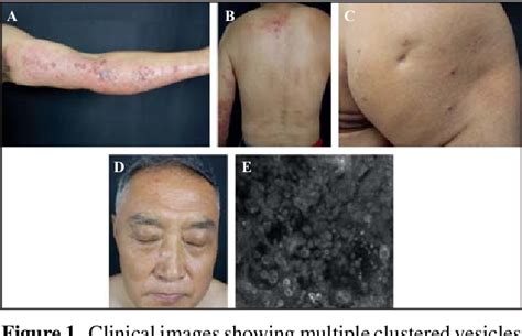 Allergic Contact Stomatitis Caused By Methacrylates Following