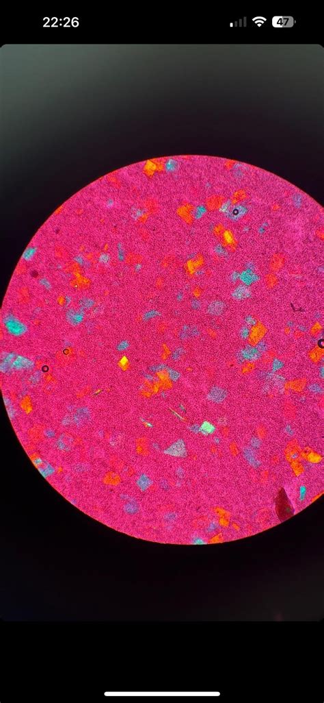 Synovial Fluid Full Of Cholesterol Crystals R Medlabprofessionals