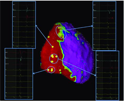 Epicardial Bipolar Voltage Mapping And The Distribution Of Abnormal Download Scientific Diagram