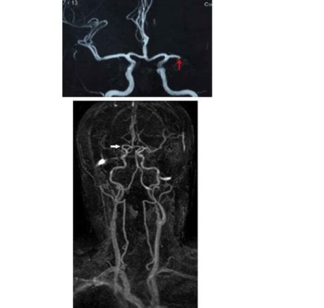 Top Tof Mra Showing Left Mca Occlusion Bottom Ce Mra Showing Download Scientific Diagram