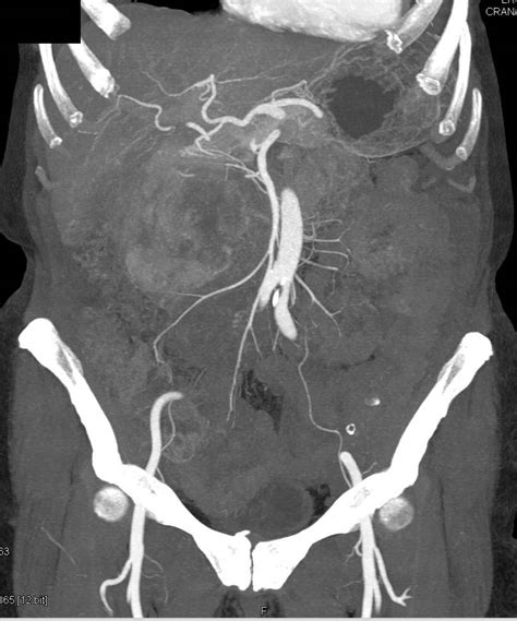 Duodenal Gist Tumor Small Bowel Case Studies Ctisus Ct Scanning Duodenal Gist Tumor Small Bowel Case Studies Ctisus Ct Scanning