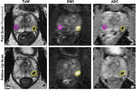 Developing Ai For Clinically Significant Prostate Cancer Diagnosis In