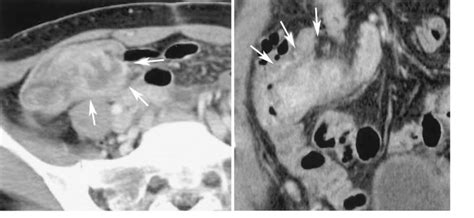 Contrast Enhanced Ct Image Of A Perforated Appendicitis In Left Axial