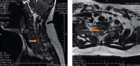 Ventral Epidural Space