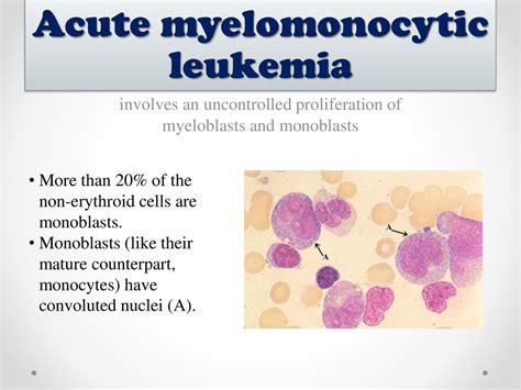 Acute Myeloid Leukemia Stages