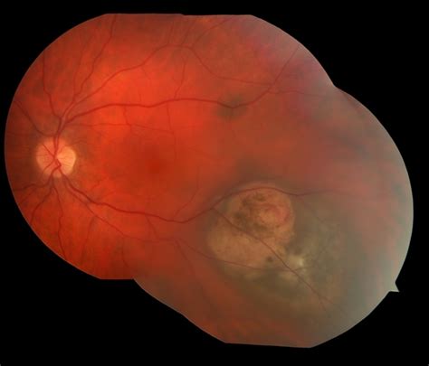 Choroidal Melanoma Retina Image Bank