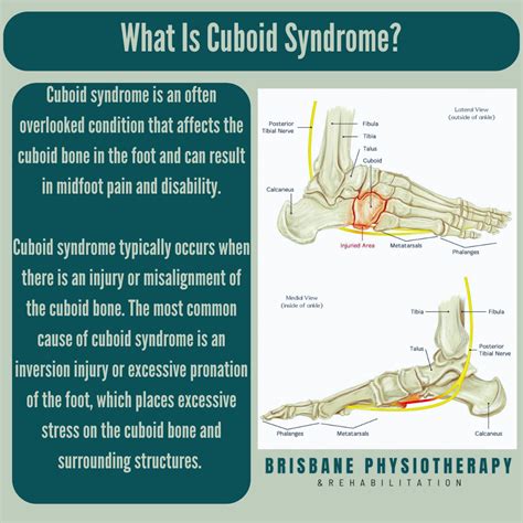 What Is Cuboid Syndrome Brisbane Physiotherapy And Podiatry