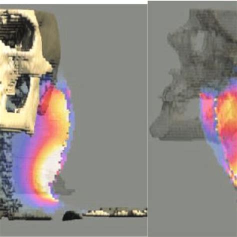 example of sar distribution calculated for the case of anatomical