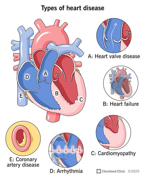 What Is The Most Common Form Of Heart Disease At William Wooden Blog