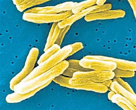 Od Pacienta S Tuberkulózou Sa Nakazili Zdravotné Sestry Regióny