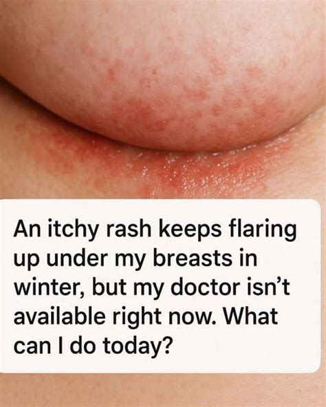 Skin Rash Under Breast Artofit