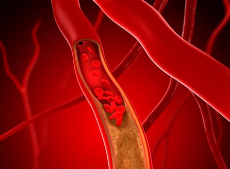 What Is Fractional Flow Reserve Ffr