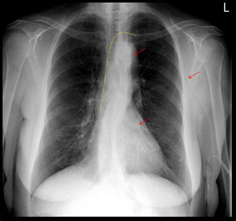 Picc Line And Palpitations Reddit