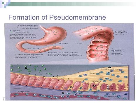 Cl Tetani Cl Difficile