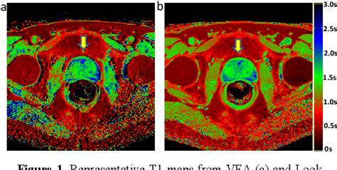 Figure 1 From Comparison Of Look Locker And Variable Flip Angle T 1 Mapping For Dce Mri In