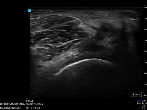Rotura De Quiste De Baker Ecografía Deportiva