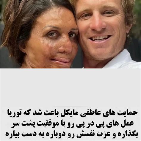 این دختر صورت سوخته لقب خوشبخت ترین زن جهان را گرفت عکس ها و علت