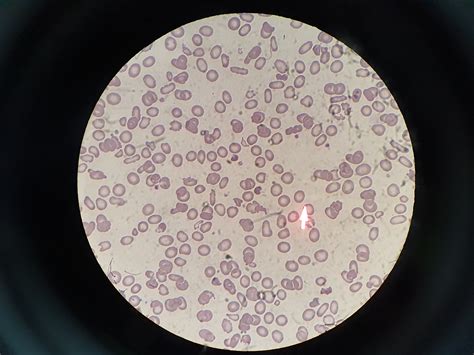 จับฉ่าย Anemia With Low Mcv คือ จับฉ่าย อายุรศาสตร์