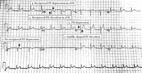 Myheart Ecg Case 001
