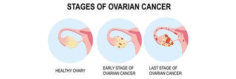 Ovarian Cancer Treatment