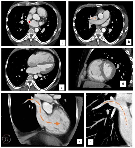 Sinus Venosus Asd