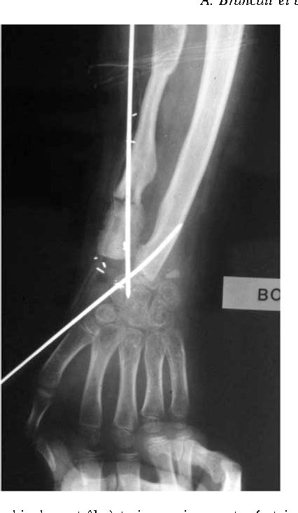 Figure 1 From Vascularized Bone Transfer Of Scapula Apophysis