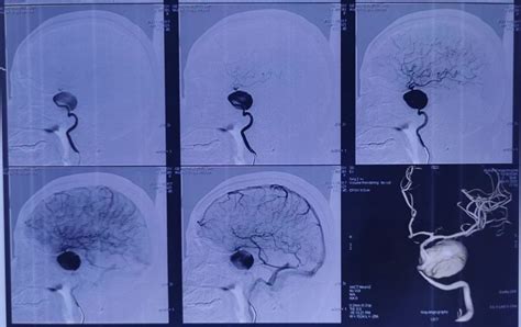 王胜 Sheng Wang On Linkedin The High Flow Bypass Of Intracranial Artery Extracranial Artery In The…