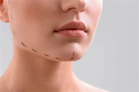 Cheek Implants Before And After Celebrities Results Explained