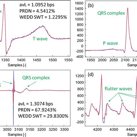 An Example Of Compression Of Ecg Signals Without And With Pathologies