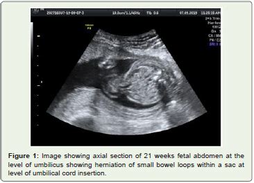 Omphalocele Ultrasound Omphalocele An Ultra Sound Teaching File