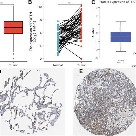 Expression Analysis Of Postn In Luad Analysis Of Gene Expression