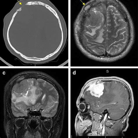 A 57 Year Old Male Patient With A Previous Left Pterional Craniotomy
