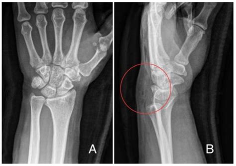 Spontaneous Rupture Of The Extensor Pollicis Longus Tendon Caused By A Wrist Sprain